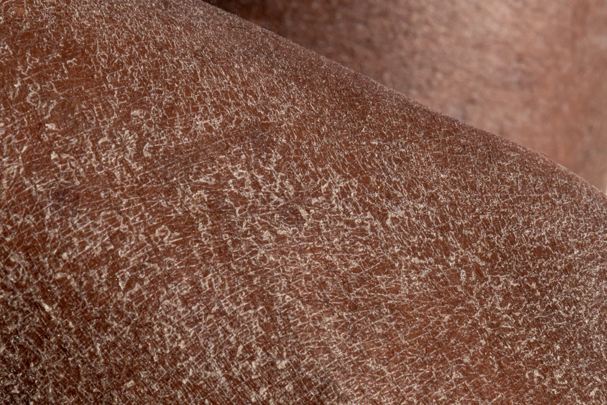 Eczema: What It Is and How to Treat It in Black Patients - BDO Pro